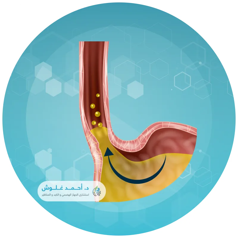 عملية ارتجاع المريء جيردكس GERDX - الموقع الرسمي للدكتور أحمد غلوش